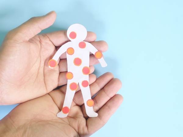 Windpocken – wenn der ganze Körper juckt - ebi-pharm.ch